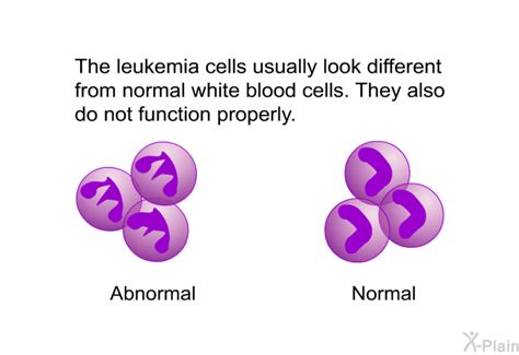 Acute Myeloid Leukemia