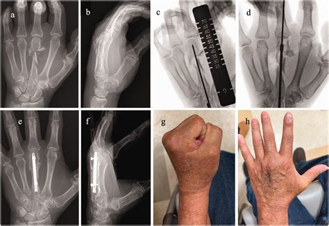 Metacarpal Fractures Alex G Lambi Robert J Rowland Nicholas W