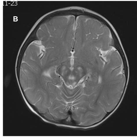 Neuroradiological Features Brain Mri Showed Bilateral Symmetric Download Scientific Diagram