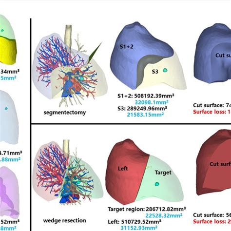 Segmentectomy Or Wedge Resection Of Ls7 8 Download Scientific Diagram
