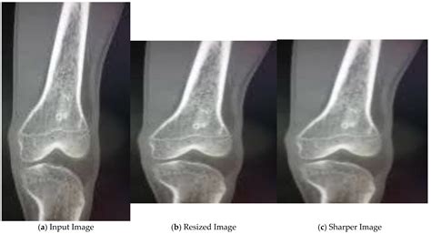 Human Bone Cancer X Ray