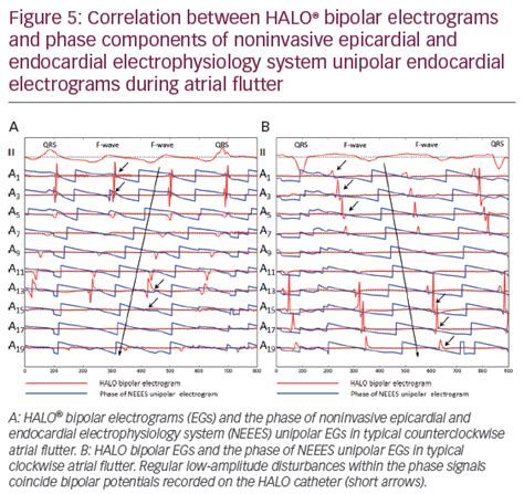 Noninvasive Phase Mapping Of Atrial Flutter In Humans Comparison With Invasive Mapping