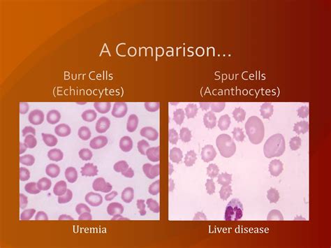 Ppt Understanding Hemolytic Anemia Clinical Insights And Management