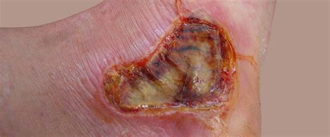 The Truth About First Degree Burn Scars What You Need To Know