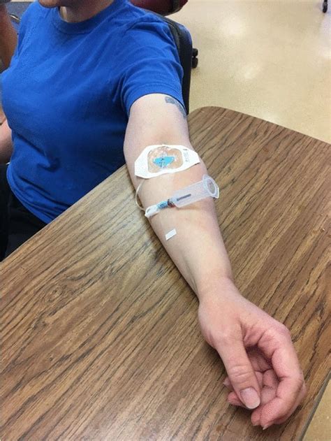 Intravenous Catheter Insertion