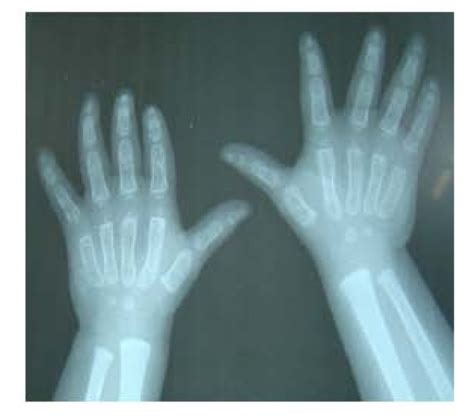 X Ray Hands Show Evidence Of Osteopenia And Uneven Fingers Download Scientific Diagram