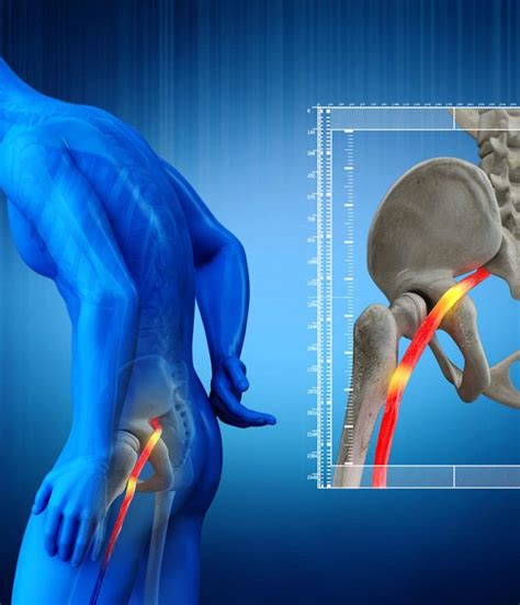 Piriformis Injection Westcare Clinic