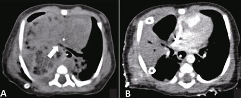 Computed Tomographic Scans Showing A Abrupt Narrowing Of The Right