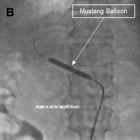A Post Tace Angiogram Showing Dissection Of The Common Hepatic Artery Download Scientific