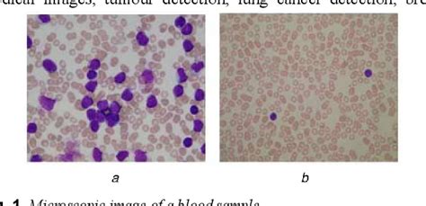 Figure 1 From Efficient Computer Aided Diagnosis Technique For Leukaemia Cancer Detection