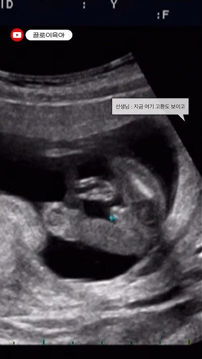 16주 초음파 성별 기형아검사 신경관결손 고위험군 정상 태아 Fetal Gender 임신 Pregnancy 반전 없는 아들 초음파 Shorts 구분 Youtube