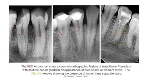 Mandibular Premolars Teeth Not To Underestimate Style Italiano Endodontics