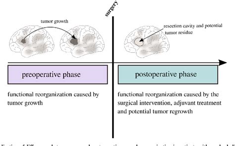 Figure 2 From Reorganization And Plasticity Of The Language Network In Patients With Cerebral