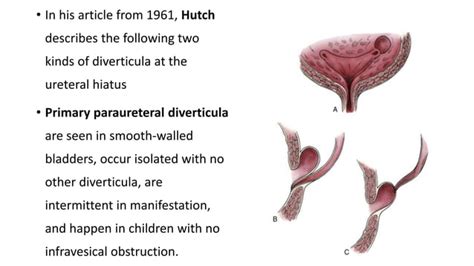 Congenital Bladder Disorders Ppt