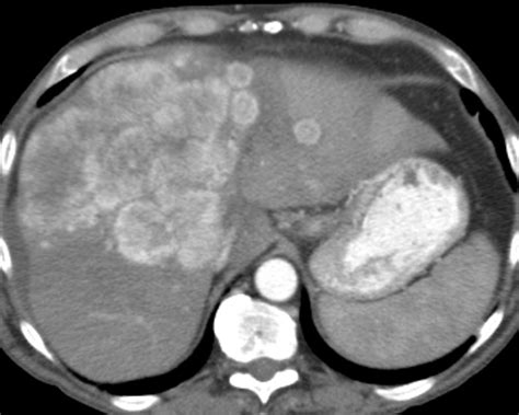 Liver Atlas Diagnosis Cholangiocarcinoma