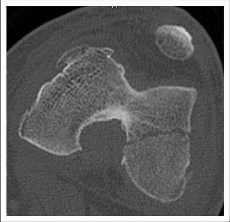 Axial Computed Tomography CT Scan With Coronal Fracture Line Download Scientific Diagram