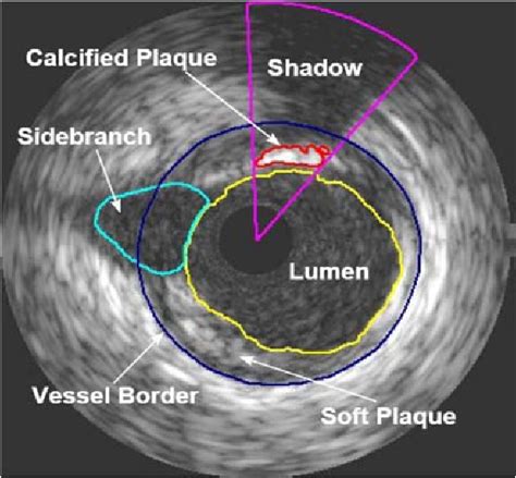 Figure 1 From Automatic Segmentation Of Intravascular Ultrasound Images Based On Temporal