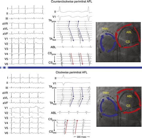 Macroreentrant Atrial Tachycardia “atypical Atrial Flutter” Clinical Gate