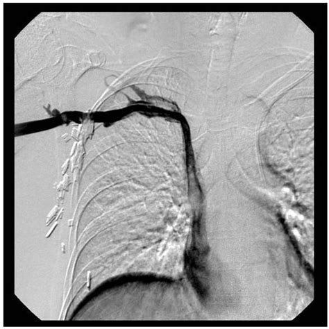 Digital Subtraction Venogram Of The Right Upper Extremity Veins And