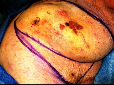 Cancer Symptoms Angiosarcoma Cancer Anti Cancer Diet