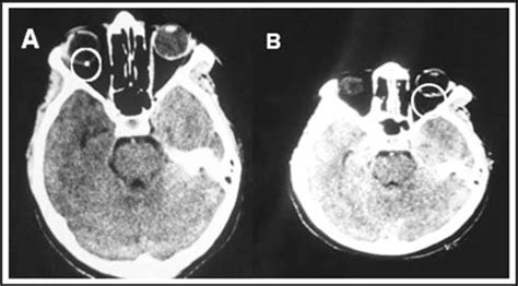 Axial Ct Scan Brain And Orbit Showing Focal Calcification Round