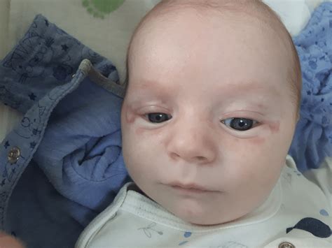 Annular And Discoid Patches With Central Hypopigmentation On The Face