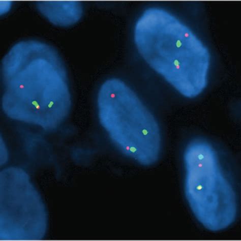 Orbital Ct Imaging Of Nodular Fasciitis A Axial View Shows A Download Scientific Diagram