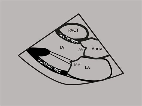 How To Read Echocardiography Of Heartpptx How To Read Echocardiography Of Heartpptx