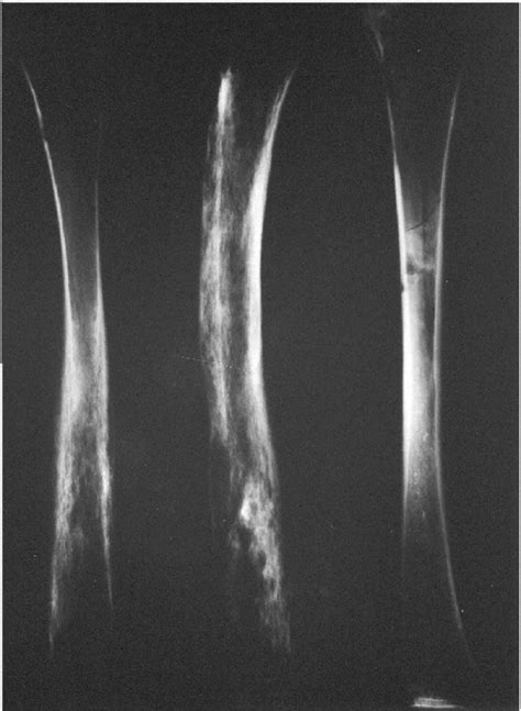 X Ray Of The Pathological Tibiae Shown On Fig On The Left And In Download Scientific