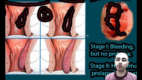 Hemorrhoids Symptoms Causes And Treatment Youtube