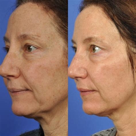 Microneedling Before And After Wrinkles See The Difference