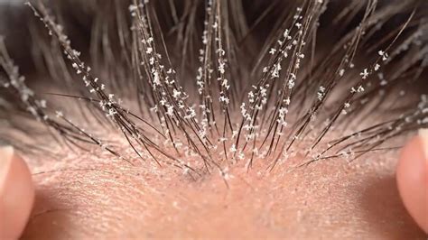 Detailed Close Up Of Human Hair Infested With Head Lice Focusing On