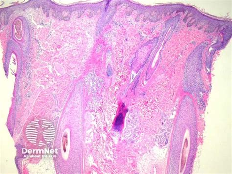 Tinea Capitis Pathology