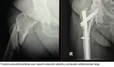 Fracturas Extracapsulares De Cadera