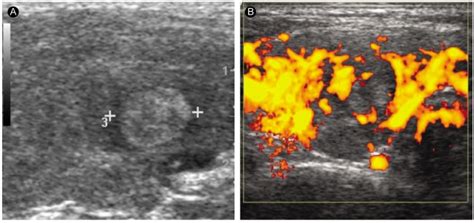A 50 Yr Old Papillary Thyroid Carcinoma Patient With Graves Disease Download Scientific