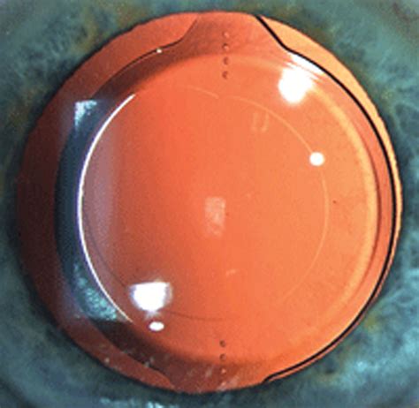 Use Predicted Refractive Astigmatism To Estimate Post Cataract Vision