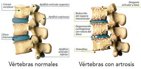 Artrosis Life Columna