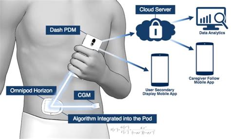 Omnipod 5 And Dexcom Closed Loop System