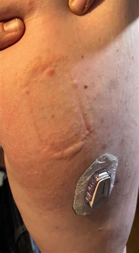 Help Me Figure Out Why Im Reacting To The Omnipod Adhesive Romnipod