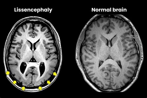 Origin Of Lissencephaly Continues To Be Uncovered Kcgmh And Nycu Research Team Discover New