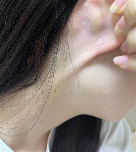 귀 뒤에 각질 습진 지식in