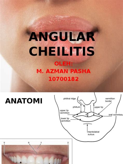 Angular Cheilitis