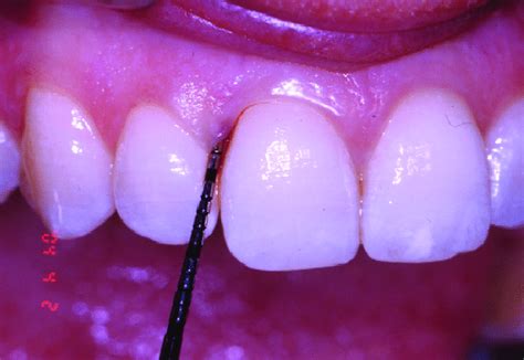 Tsp At The Distal Facial Interproximal Site Of Tooth 8 The Probe Was Download Scientific