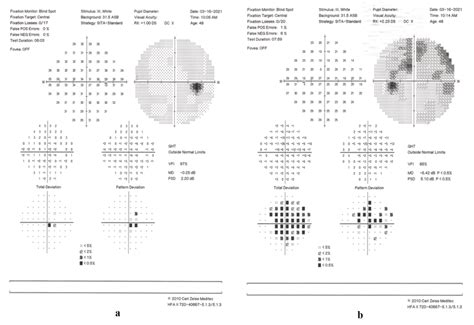 Examination Of The 30° Visual Field Of Both Eyes A B A Paracentral