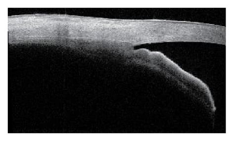 a original ss oct image b segmented binary image c segmented