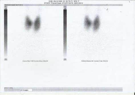 Study Of Thyroid Scan Of Patient 11 With ID 52 79 71 SEX F Download Scientific Diagram