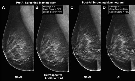 Improved Breast Cancer Detection With Artificial Intelligence In A Real World Digital Breast