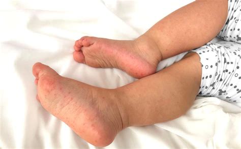 手・足・口に赤い発疹や水ぶくれが出る 手足口病 てあしくちびょう Medical Terrace