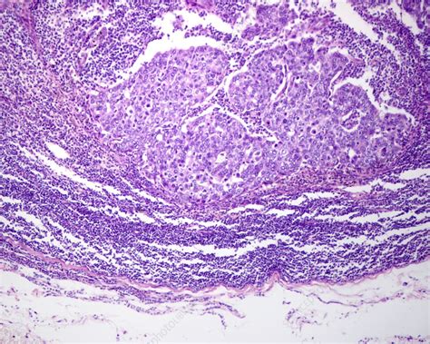 Carcinoma Metastasis To The Lymph Node Light Micrograph Stock Image C060 3320 Science
