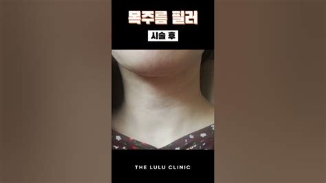 목주름필러 시술 전과 후는 어떻게 다를까 Youtube
